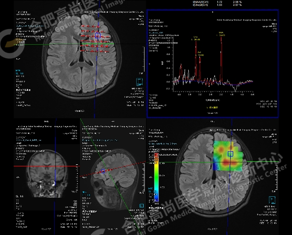 病例科普：头颅MR诊断局灶性皮层发育不良（FCD） - 知乎