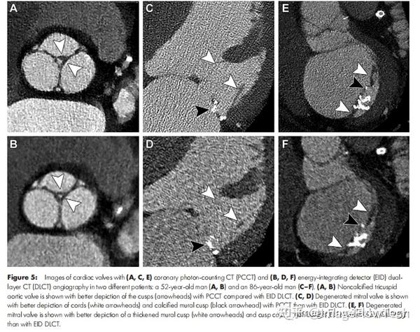 第43期: CT成像的下一个时代：光子计数CT - 知乎