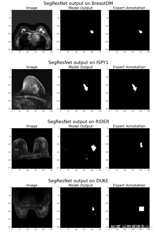 BC-MRI-SEG数据集：首个统一的乳腺癌MRI肿瘤分割基准，推动深度学习模型的泛化能力 - 知乎
