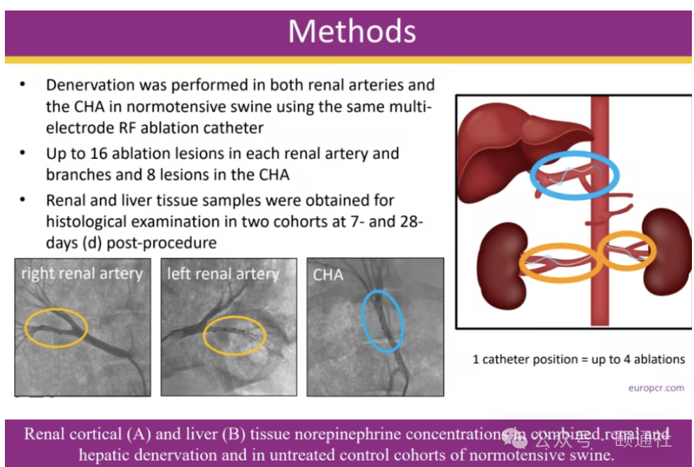 RDN新突破：全球首例！美敦力多器官去神经术向"沉默杀手"发起新攻势 - 知乎