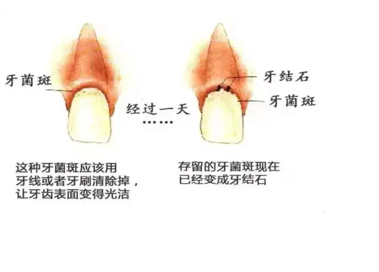 国际上最标准刷牙法——巴氏刷牙 知乎