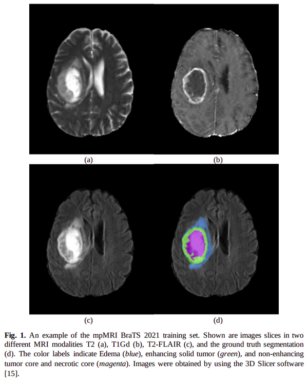 【arXiv:2112】使用多参数 MRI 进行 GBM 肿瘤分割的集成 CNN 网络 - 知乎