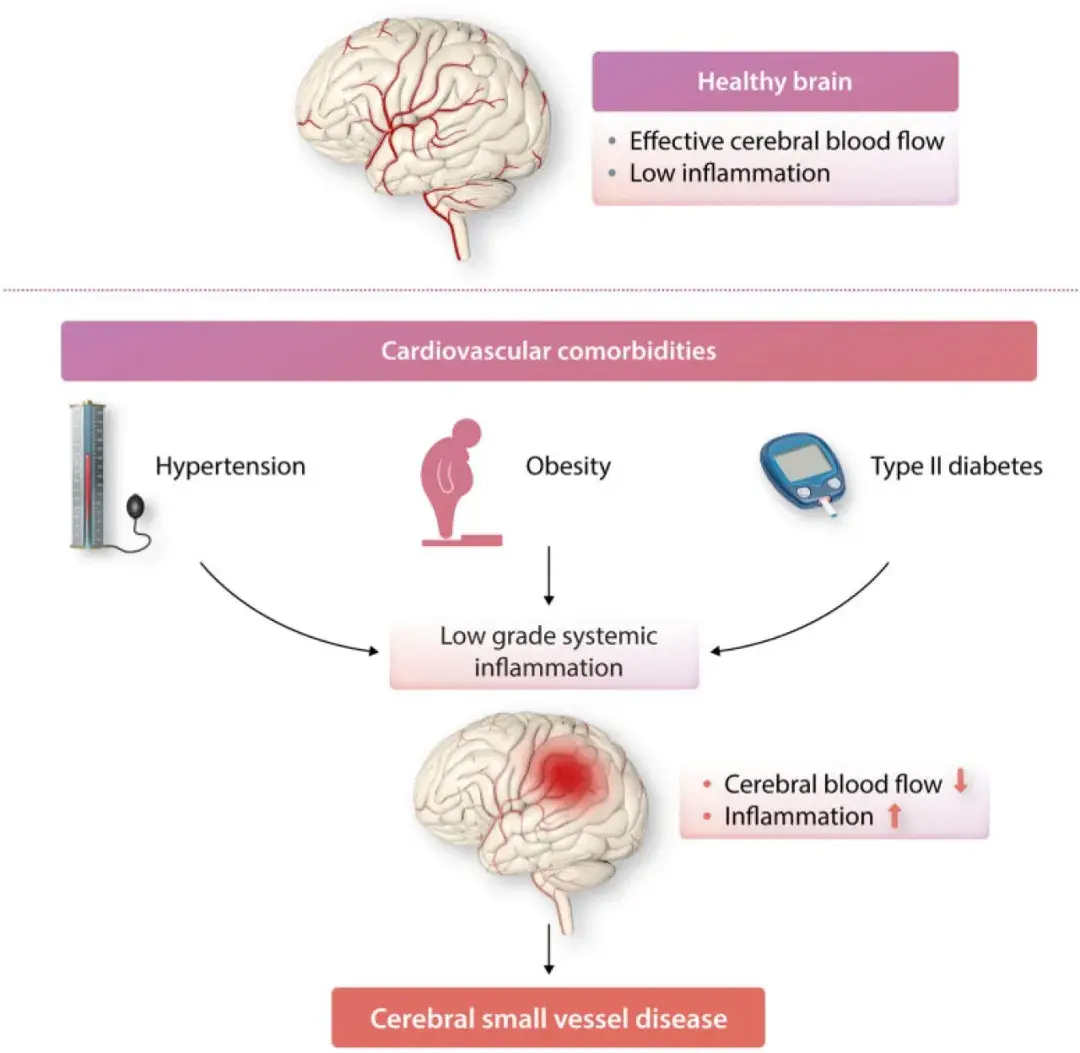 Cardiovasc Res|Stuart M Allan团队总结了慢性心血管疾病相关炎症影响cSVD的分子机制 - 知乎