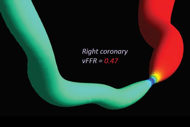临床心脏病专家如何利用CFD仿真技术评估适用的治疗手段？ - 知乎