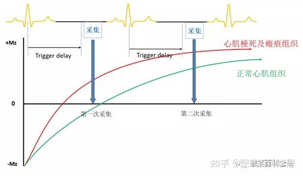 PSIR序列原理及临床应用 - 知乎