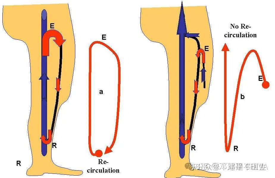 CHIVA语言中的Shunt概念与分类 - 知乎