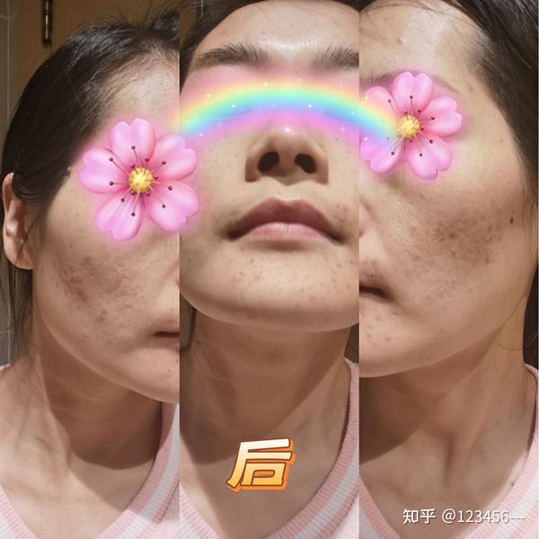 痘痘战痘士,胜利了 知乎