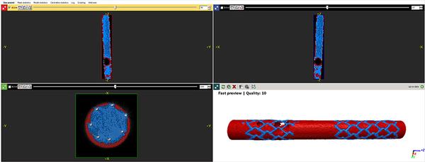 【Simpleware】分析冠状动脉支架血栓形成 - 知乎
