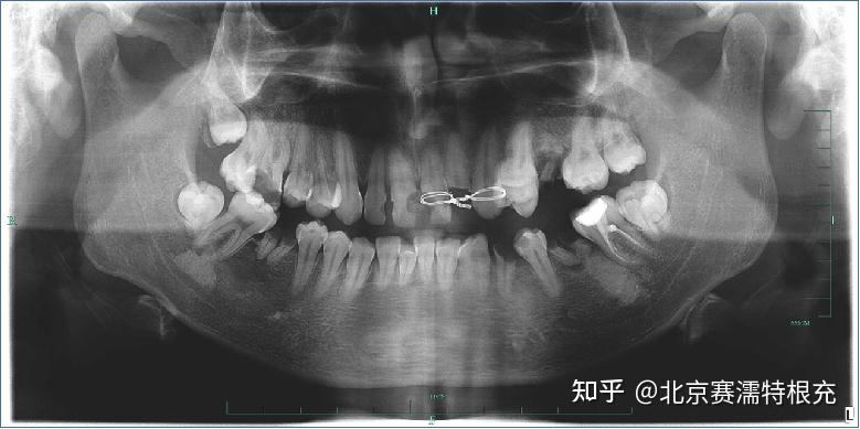 上前牙区治疗一例 | 祝自洋医生使用C-Root SP经典充填案例！ - 知乎