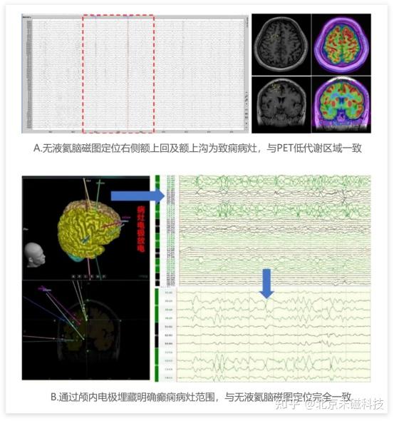 全球首台256通道无液氦脑磁图仪正式发布 - 知乎