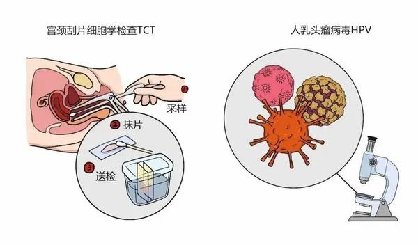 TCT提示中度炎症需要治疗吗？ - 知乎