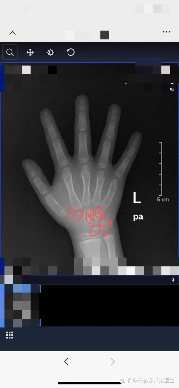 医院的TW3是如何看出5岁骨龄的？ - 知乎