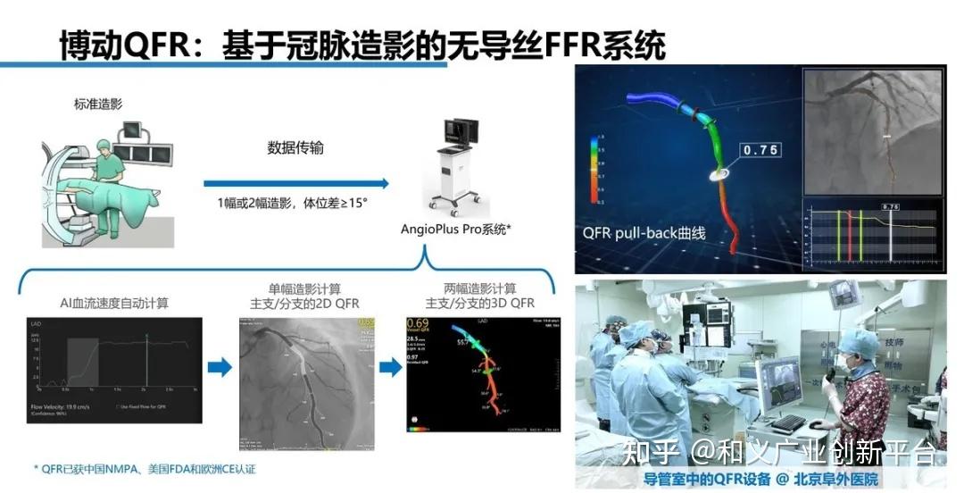 血流储备分数3——盘点：国内外FFRct重点企业 - 知乎