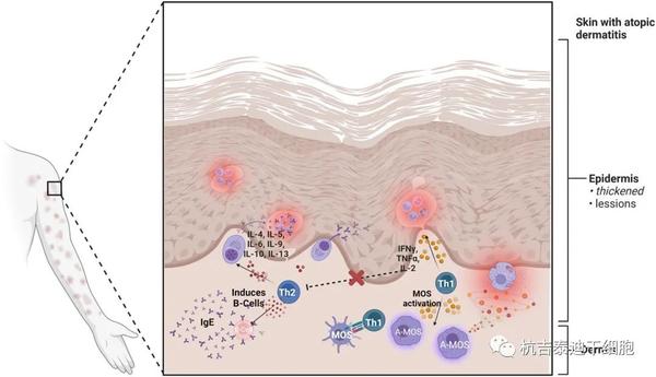 间充质干细胞治疗特应性皮炎的临床研究进展 - 知乎