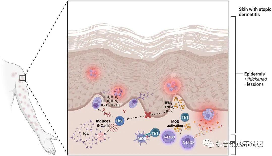 间充质干细胞治疗特应性皮炎的临床研究进展 - 知乎