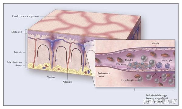 Nejm 2009 Case 5 - 知乎