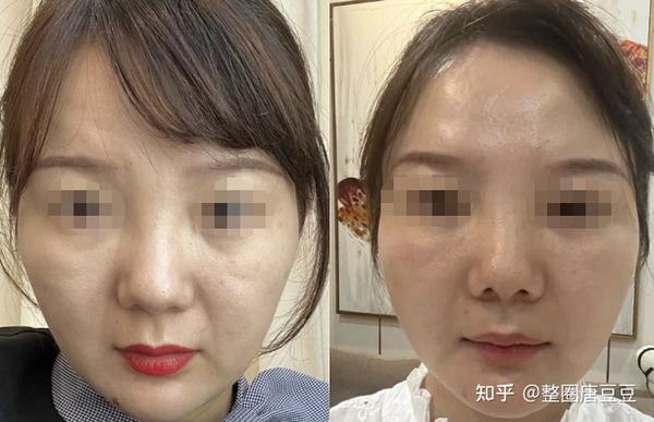 花1万多做超声炮值不值?超声炮是智商税吗?过来人告诉你真实效果 知乎