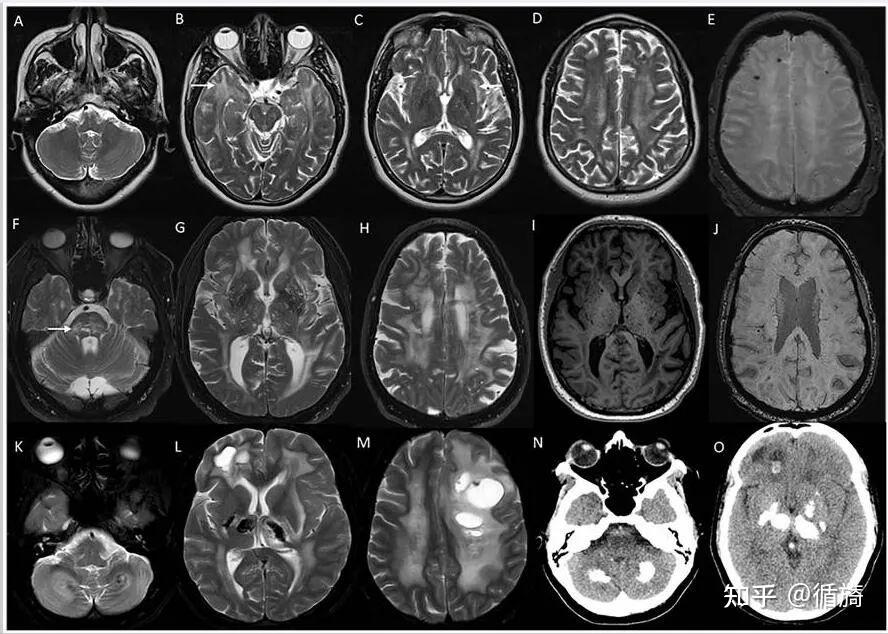 脑白质营养不良：成人发病类型的影像指南与最新治疗 - 知乎