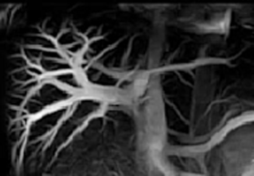 什么是动脉自旋标记 (ASL)，它如何改善 MRA？ - 知乎