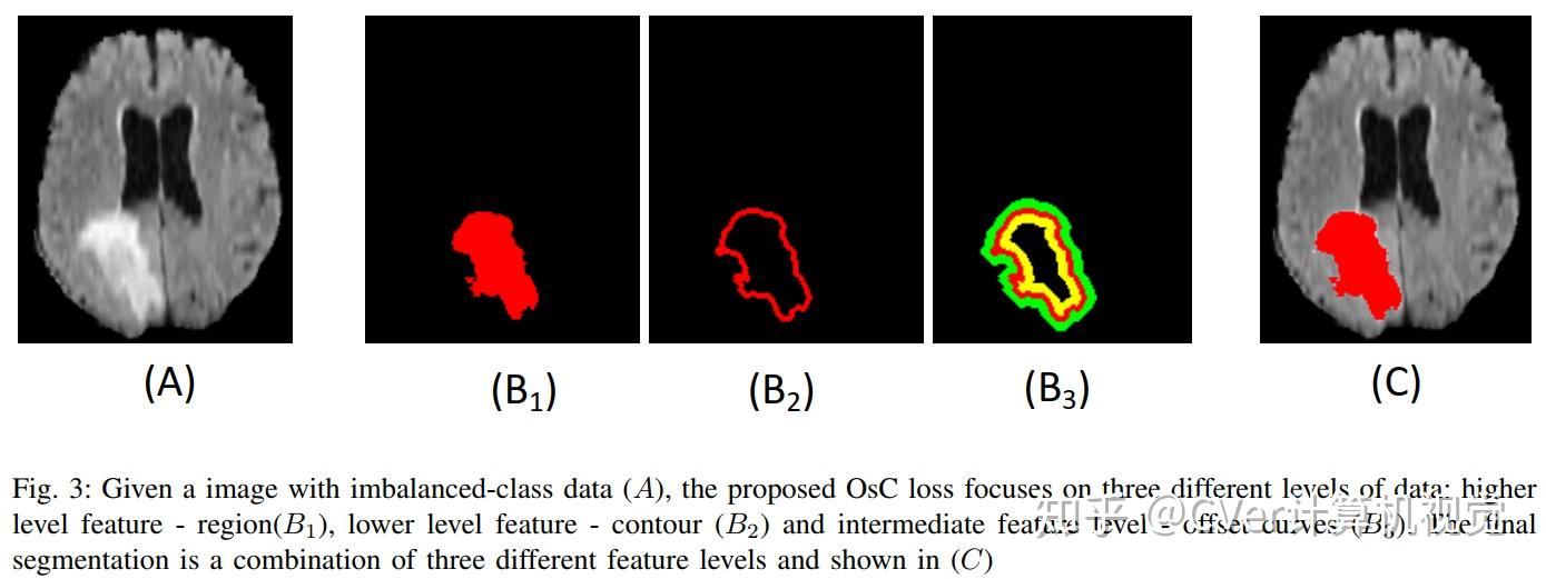 OsC Los：用于医学图像分割中不平衡问题的偏移曲线损失 - 知乎