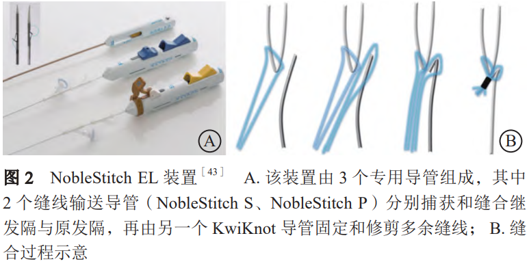 卵圆孔未闭非永久置入性介入治疗的进展 - 知乎
