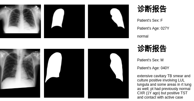 Montgomery County CXR Set 数据集介绍：CXR 图像异常诊断报告 - 知乎