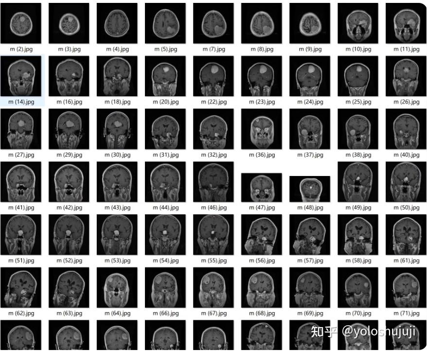脑肿瘤MRI图像检测数据集 5,249 张 MRI 图像，分为训练集和验证集。图像YOLO 格式，对应4类脑肿瘤标签。0 类：神经胶质瘤1 类：脑膜瘤2 类：无肿 3类：垂体 医学类数据集 - 知乎