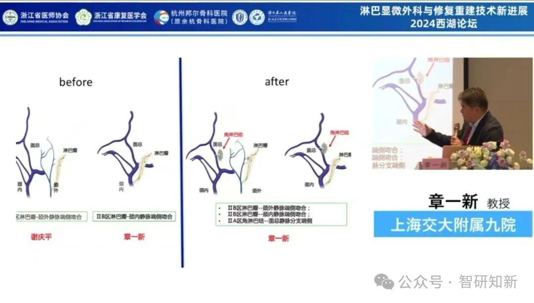 颈深淋巴-静脉吻合术（LVA）与AD - 知乎