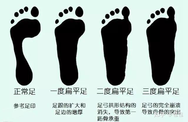 扁平足怎么办？一文详解扁平足（附康复方案） - 知乎