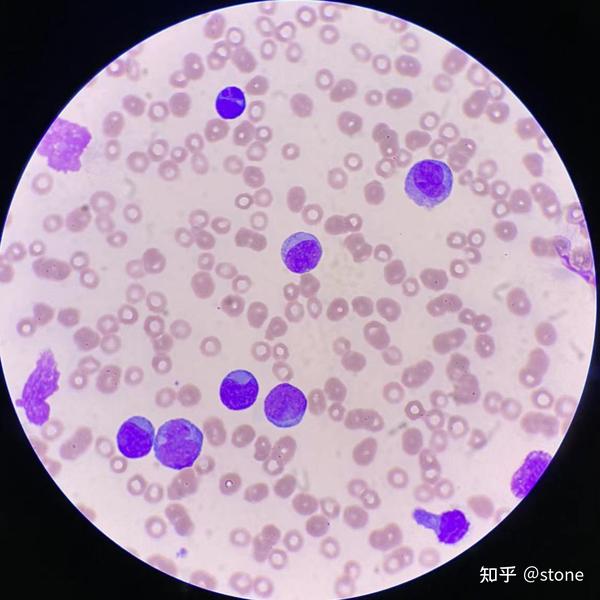 13-2022112721320009084650-W54-AML-M2 - 知乎