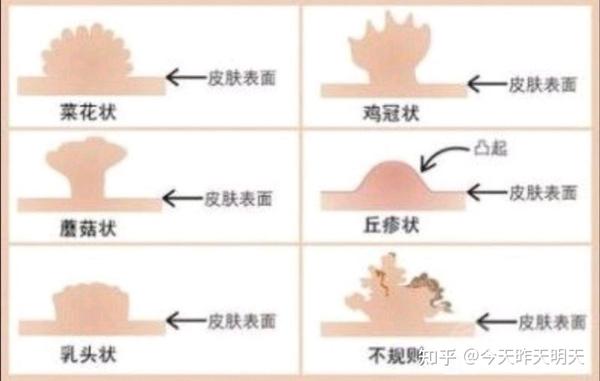 尖锐湿疣多次反复怎么办？ 知乎