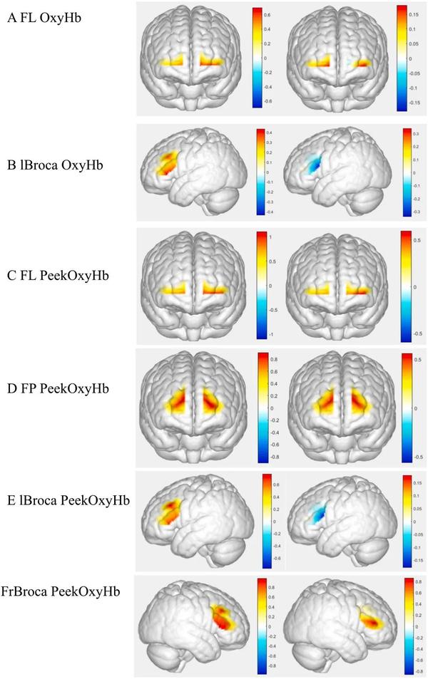 Journal of Affective Disorders: θ爆发式经颅磁刺激治疗焦虑和抑郁的FNIRS证据 - 知乎