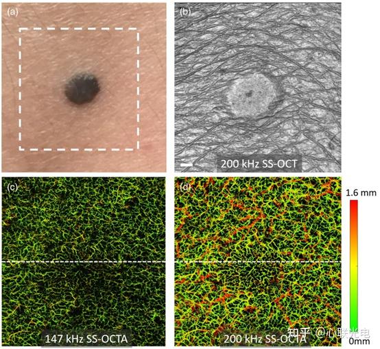 J Biomed Opt：长距离swept-source OCTA在皮肤微循环成像方面的优越性 - 知乎