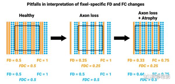 基于扩散磁共振成像的FBA（Fixel-Based Analysis）分析 - 知乎