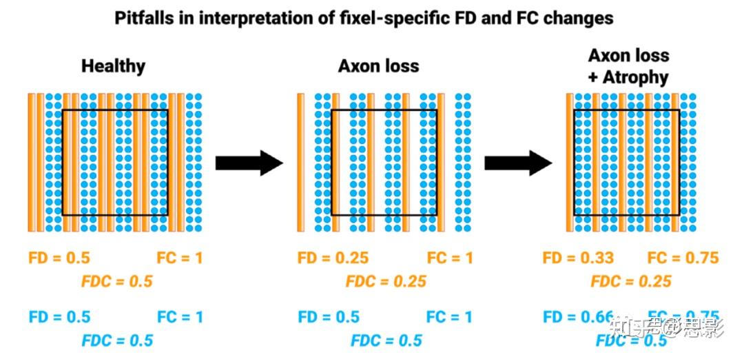 基于扩散磁共振成像的FBA（Fixel-Based Analysis）分析 - 知乎