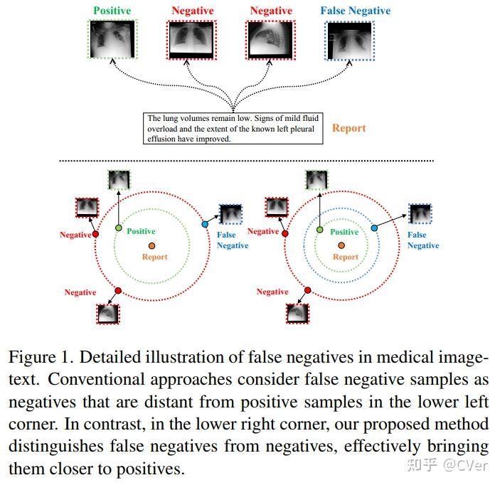 CVPR 2024 | MLIP：增强医学视觉表示！利用发散编码器和知识引导对比学习 - 知乎