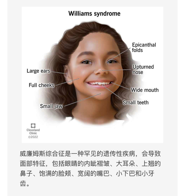 听觉过敏hyperacusis一种即陌生又常见的听力障碍 - 知乎