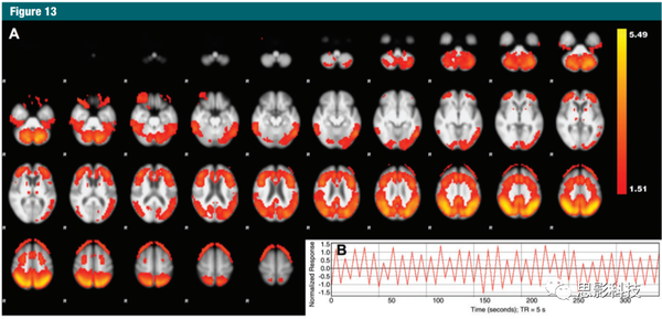 Radiology：大脑动脉自旋标记（ASL)灌注方法介绍 - 知乎