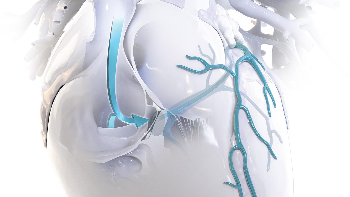 Baylis医疗公司凭什么得到波士顿科学的青睐？ - 知乎