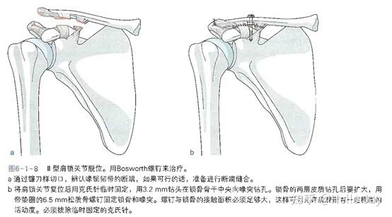 锁骨骨折的治疗原则 - 知乎