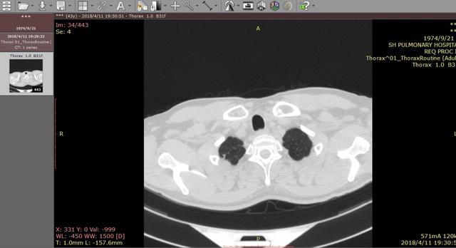 分享一个可以打开医院拷贝的原始格式(DICOM)影像资料的免费软件 - 知乎