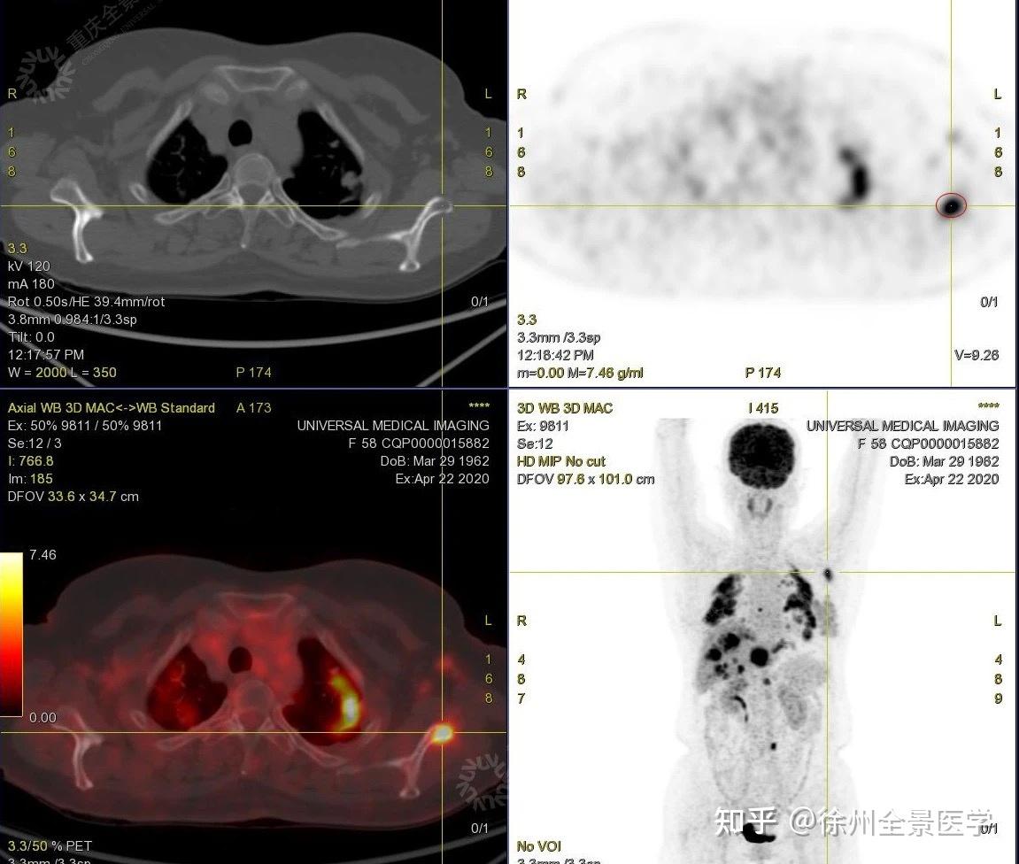 本以为是感冒咳嗽，PET/CT诊断竟是乳腺癌？！ - 知乎