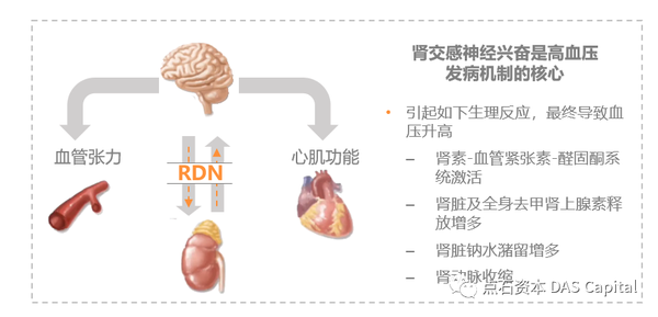 行研 | 十年一剑千秋史，RDN将引领微创手术治疗慢性疾病的颠覆性趋势？ - 知乎