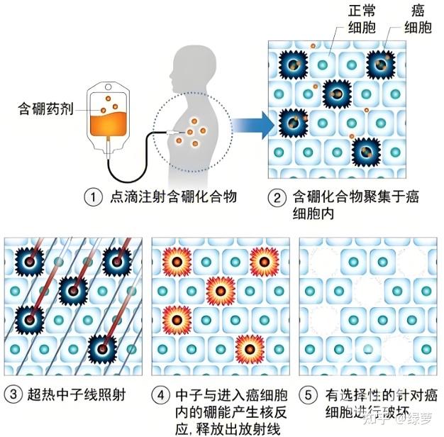 硼中子俘获疗法(BNCT)：抗癌领域的璀璨新星 - 知乎