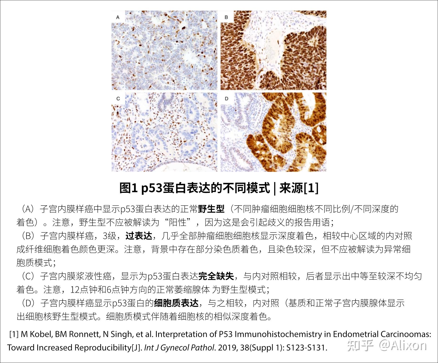 p53免疫组化判读结果标准及基因变异相关性 - 知乎