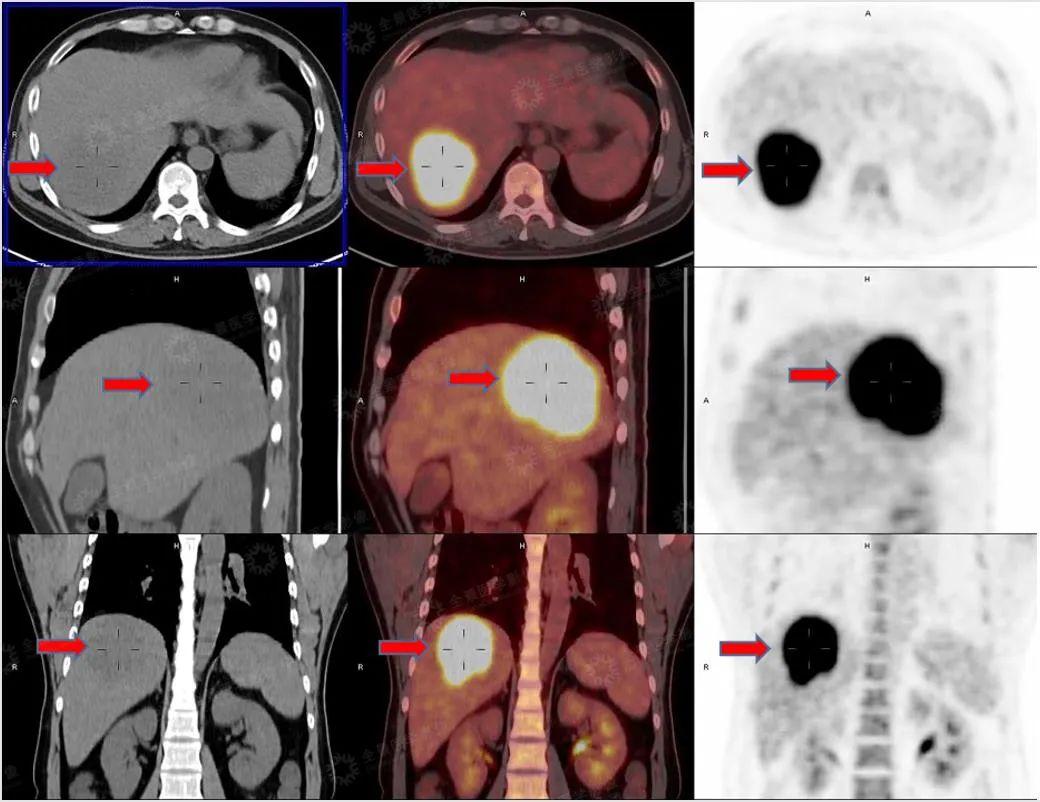 肝脏占位难定性，PET/CT-MR异机融合鉴良恶！ - 知乎