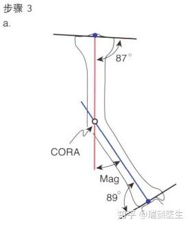《矫形外科原则》读书笔记（二）-胫骨机械轴及解剖轴分析 - 知乎