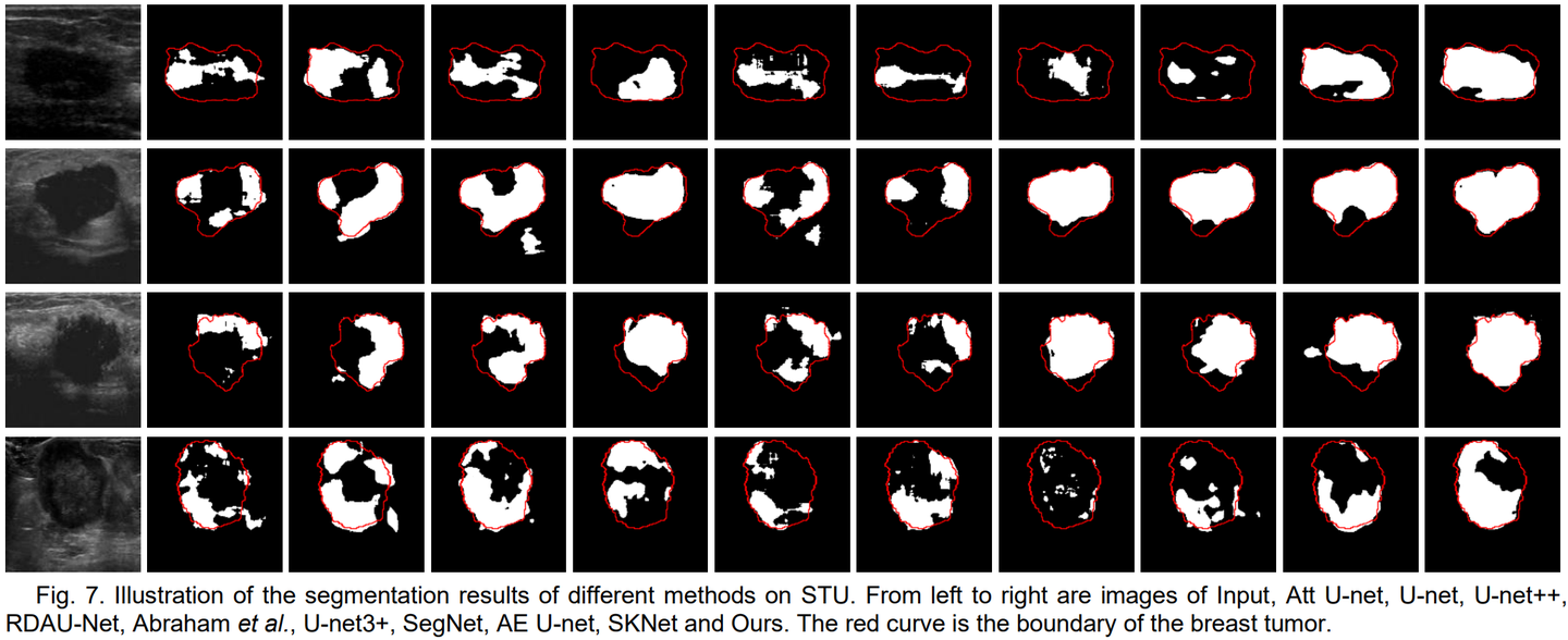 【TMI 2023】AAU-Net：一种用于超声图像中乳腺病变分割的适应性注意力U-Net（AAU-net） - 知乎