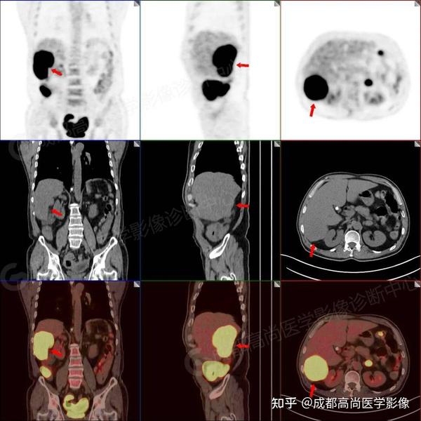 【高尚病例】PET-CT/MRI多模态检查实现“一站式”诊断 - 知乎