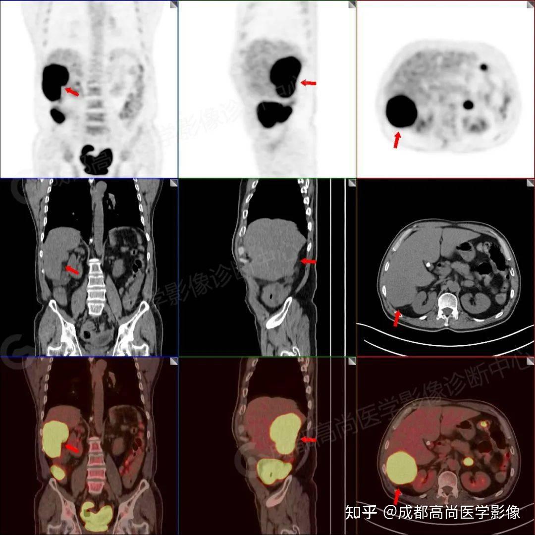 【高尚病例】PET-CT/MRI多模态检查实现“一站式”诊断 - 知乎
